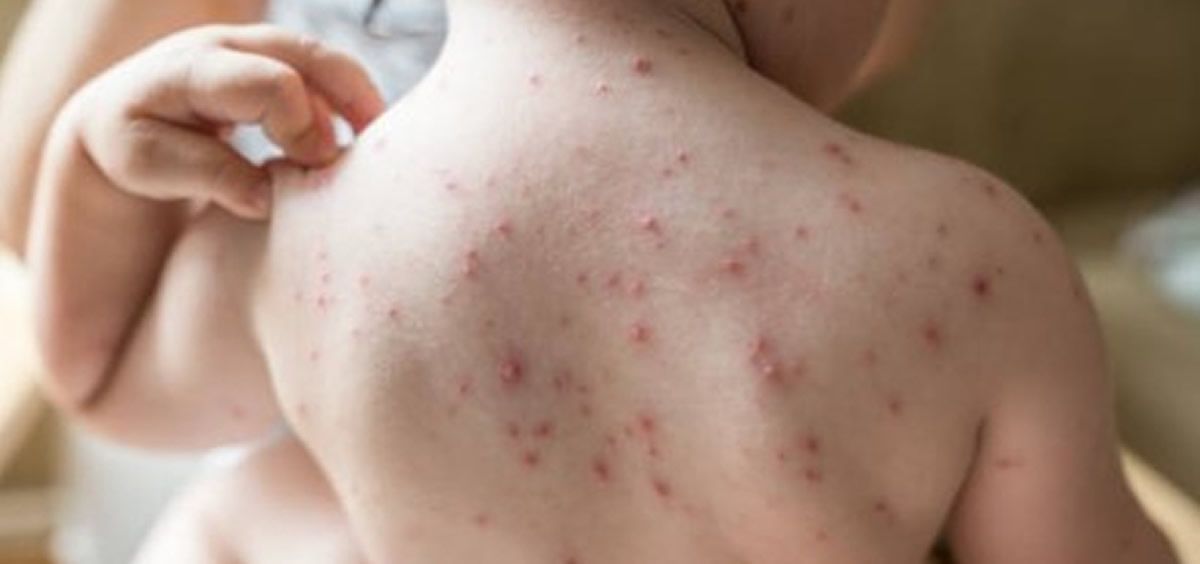 ¿Qué es un molusco y cuáles son sus síntomas? | ConSalud